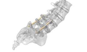 PEEK Medical Device Components - Victrex